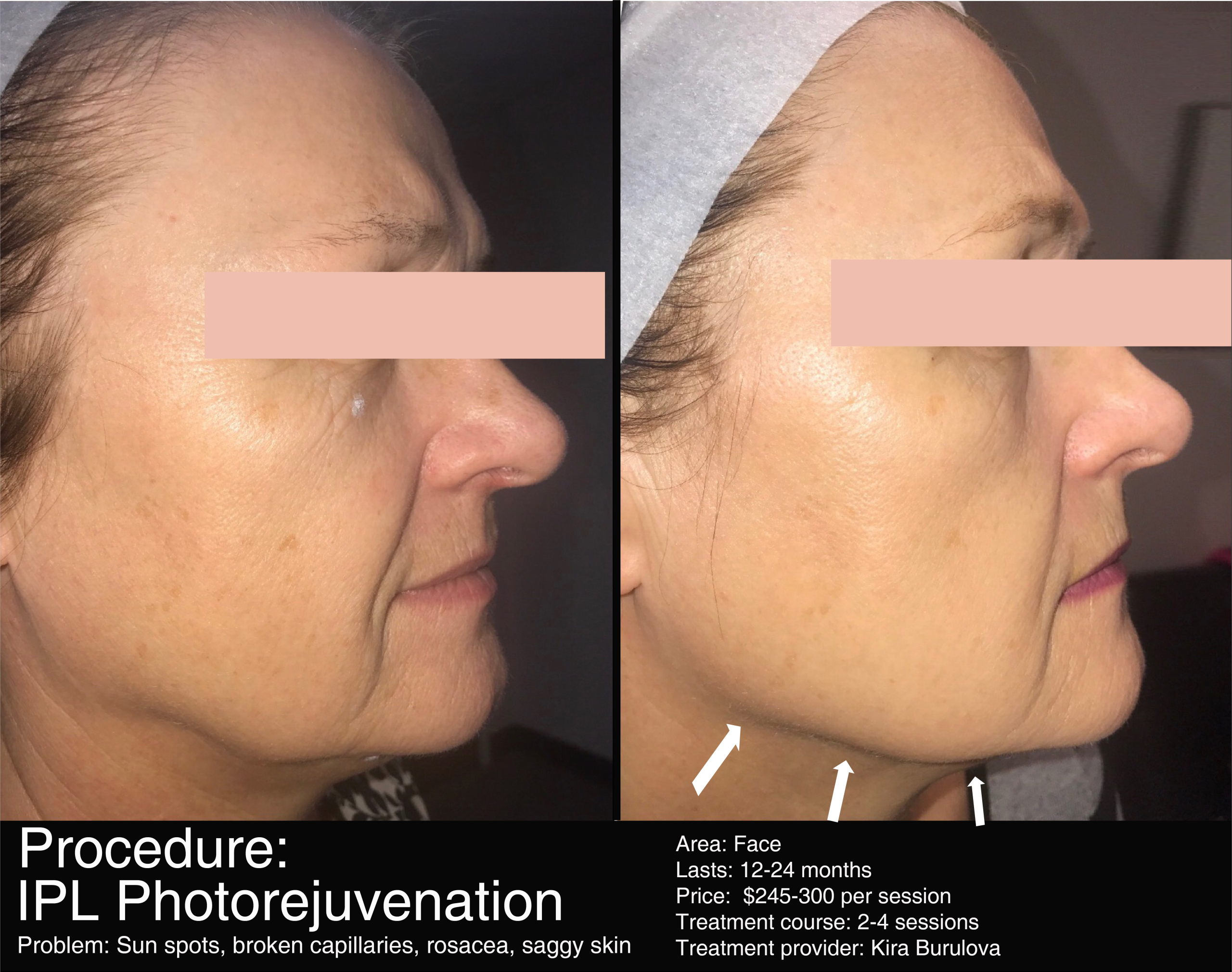 Gallery. Prolase Medispa - Laser Hair Removal and Skin Care Center