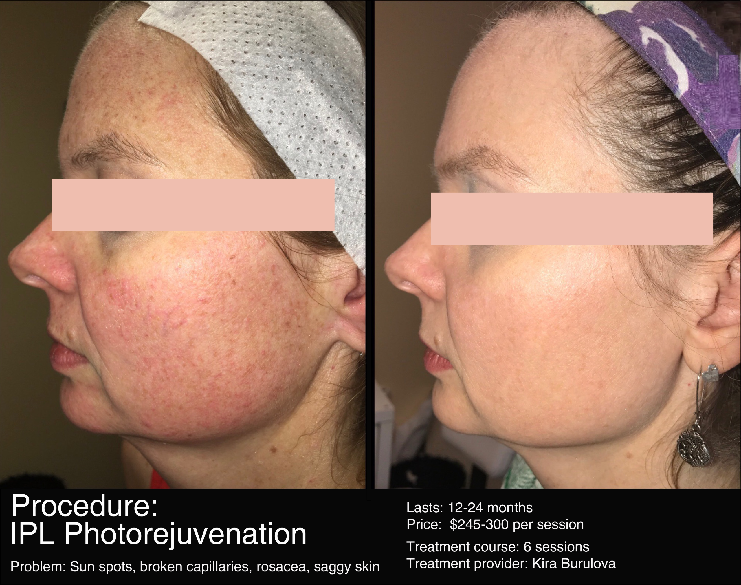 Gallery. Prolase Medispa - Laser Hair Removal and Skin Care Center