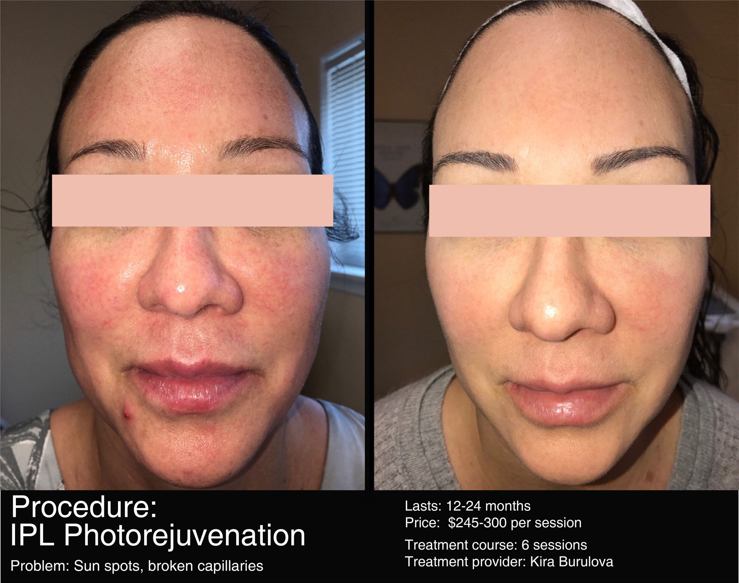 Gallery. Prolase Medispa - Laser Hair Removal and Skin Care Center