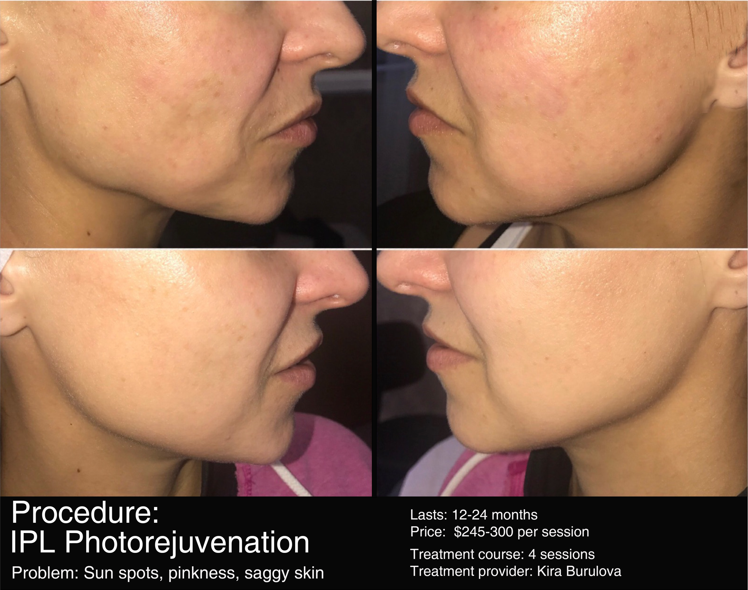 Gallery. Prolase Medispa - Laser Hair Removal and Skin Care Center