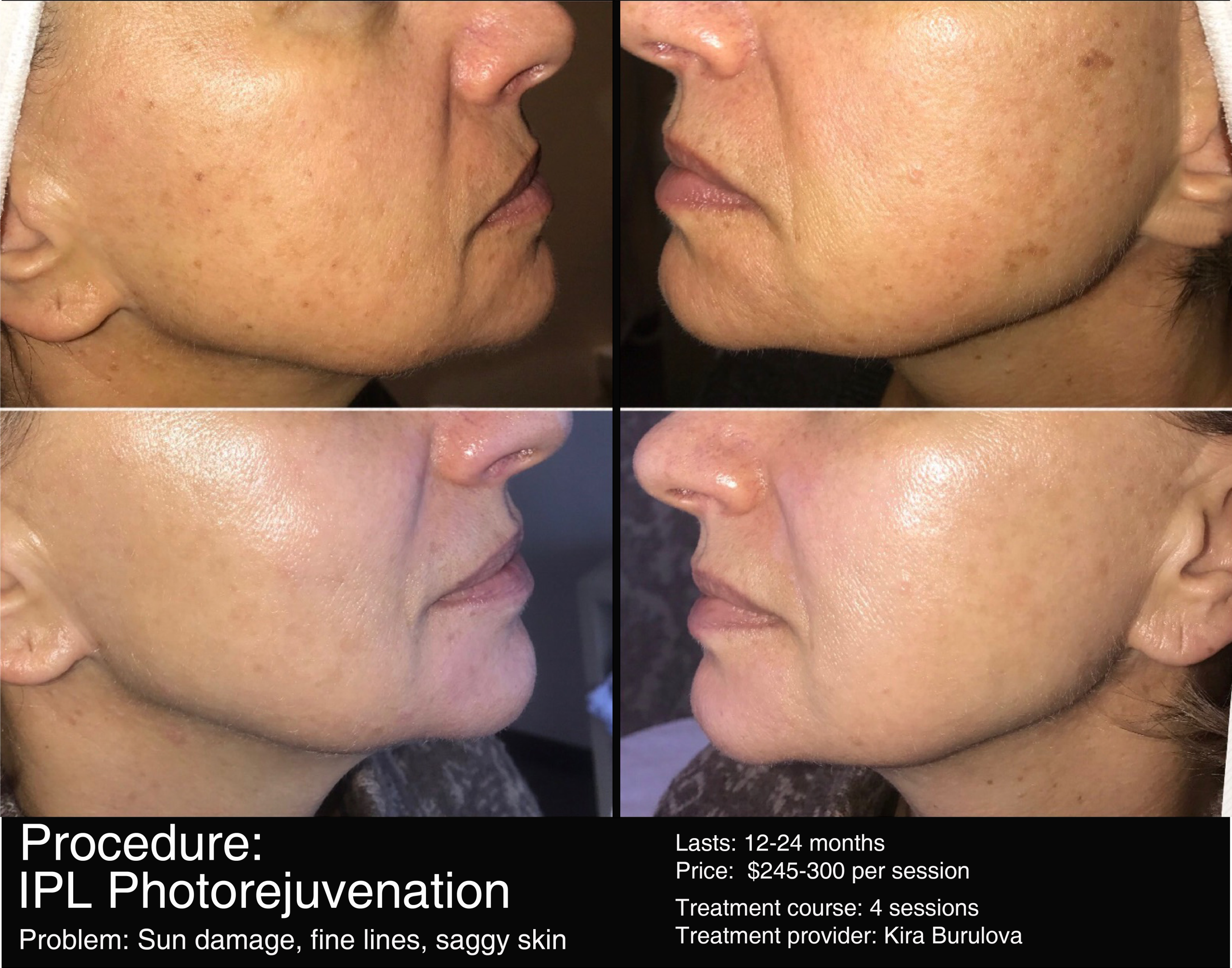 Gallery. Prolase Medispa - Laser Hair Removal and Skin Care Center