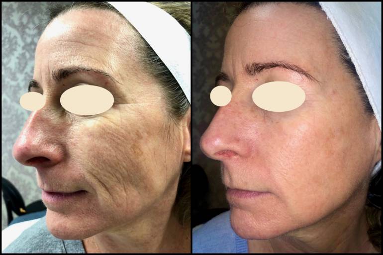 Laser 360 Rejuvenation - Prolase Medispa | #1 Laser Hair Removal in DMV