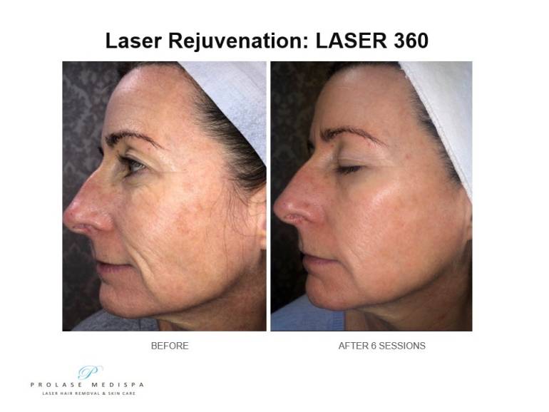 Laser Treatments - Prolase Medispa | #1 Laser Hair Removal in DMV
