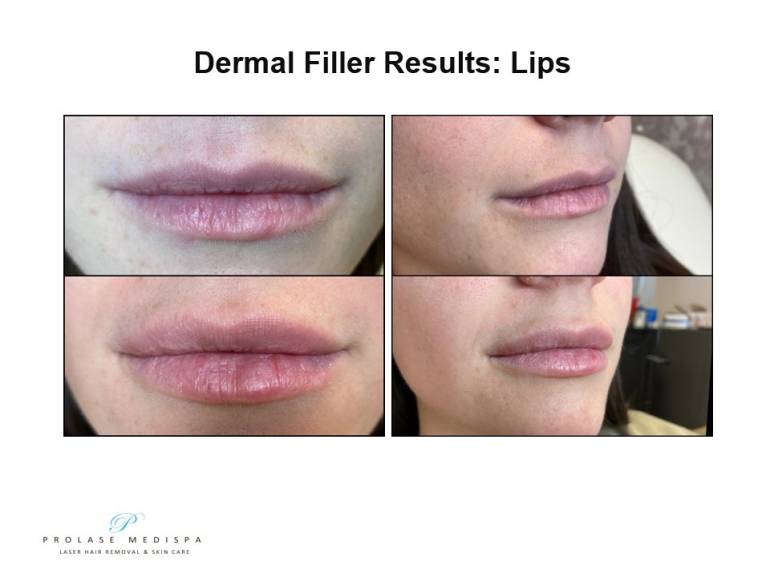 Injectables Photo Gallery - Prolase Medispa | #1 Laser Hair Removal in DMV