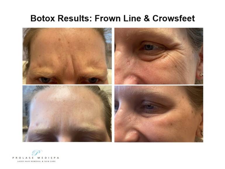 Injectables Photo Gallery - Prolase Medispa | #1 Laser Hair Removal in DMV