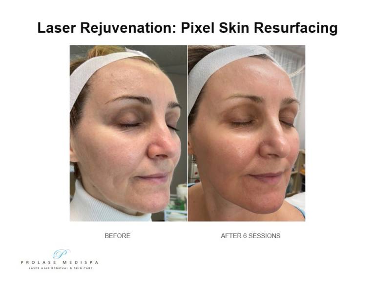 Laser Treatments - Prolase Medispa | #1 Laser Hair Removal in DMV