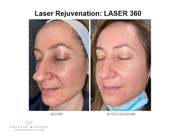 Laser Treatments - Prolase Medispa | #1 Laser Hair Removal in DMV