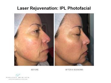 Laser Treatments - Prolase Medispa | #1 Laser Hair Removal in DMV