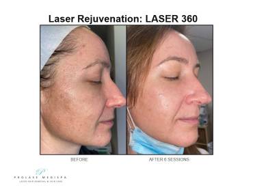 Laser Treatments - Prolase Medispa | #1 Laser Hair Removal in DMV