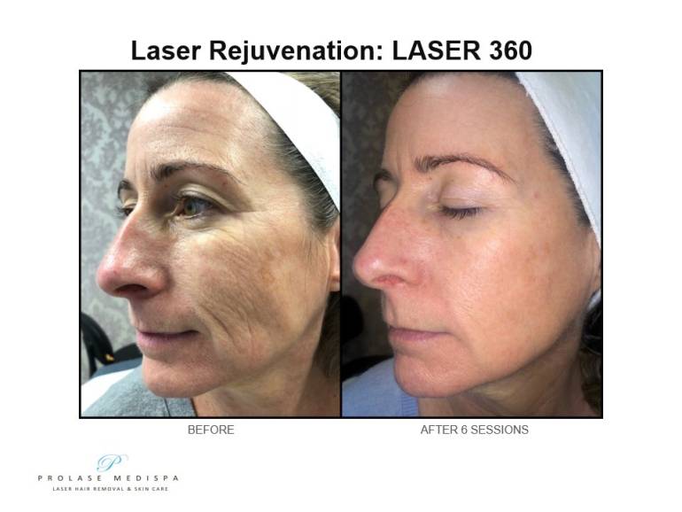 Laser Treatments - Prolase Medispa | #1 Laser Hair Removal in DMV