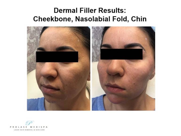Injectables Photo Gallery - Prolase Medispa | #1 Laser Hair Removal in DMV