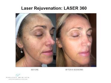Laser Treatments - Prolase Medispa | #1 Laser Hair Removal in DMV