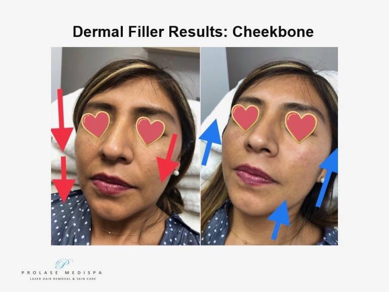 Injectables Photo Gallery - Prolase Medispa | #1 Laser Hair Removal in DMV