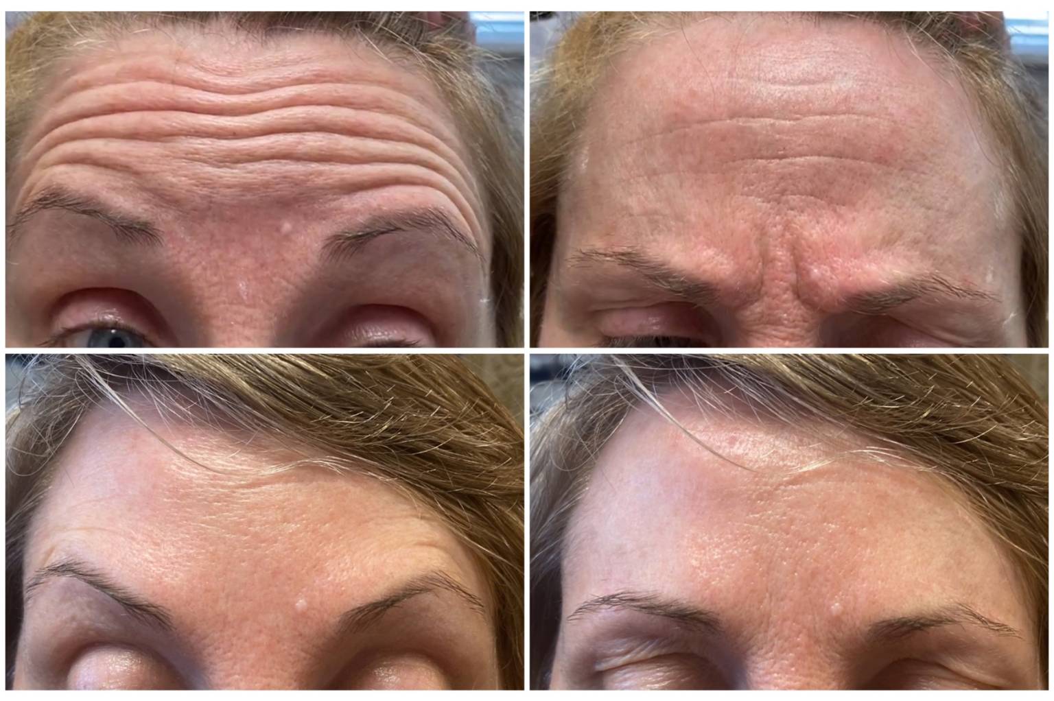 Injectables Photo Gallery - Prolase Medispa | #1 Laser Hair Removal in DMV