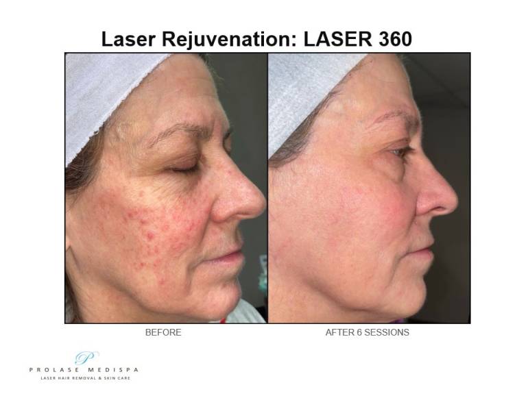 Laser Treatments - Prolase Medispa | #1 Laser Hair Removal in DMV