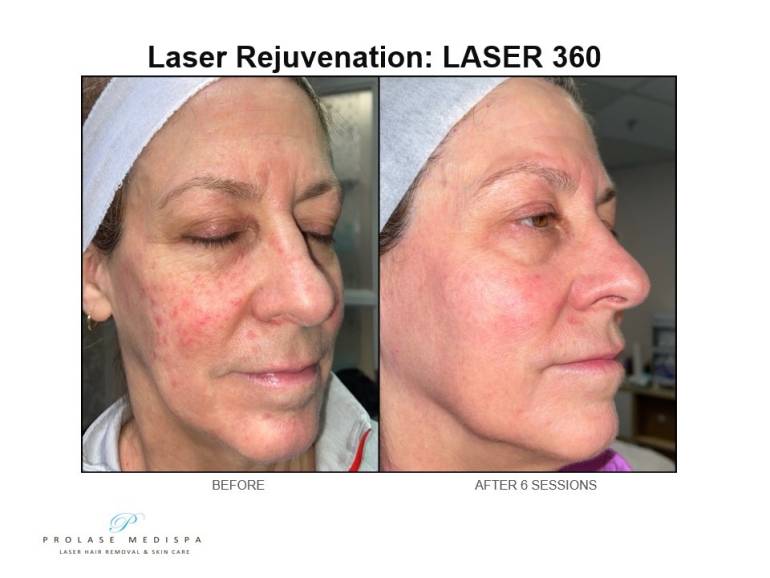 Laser Treatments - Prolase Medispa | #1 Laser Hair Removal in DMV