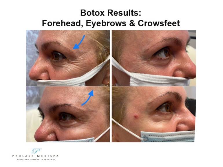 Injectables Photo Gallery - Prolase Medispa | #1 Laser Hair Removal in DMV