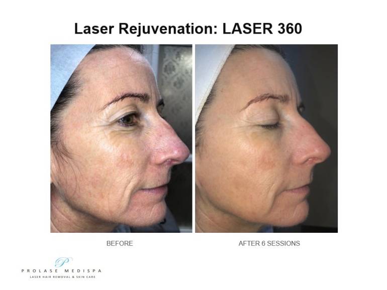 Laser Treatments - Prolase Medispa | #1 Laser Hair Removal in DMV