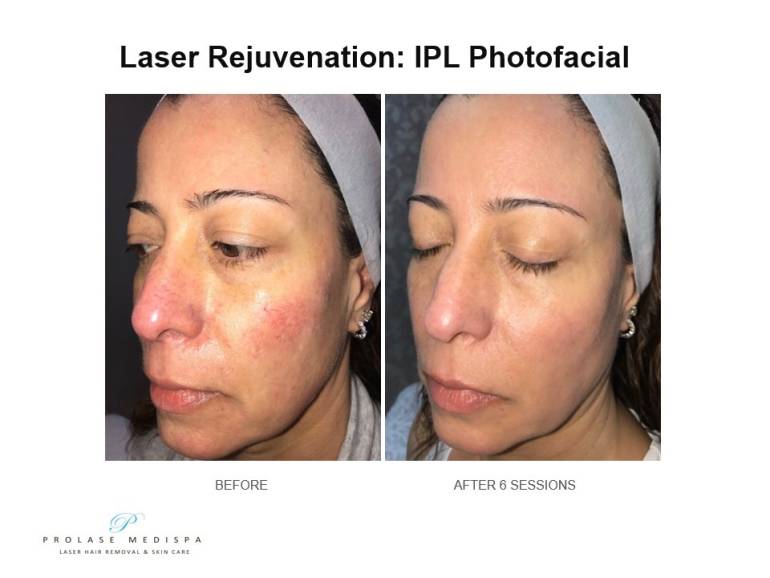 Laser Treatments - Prolase Medispa | #1 Laser Hair Removal in DMV