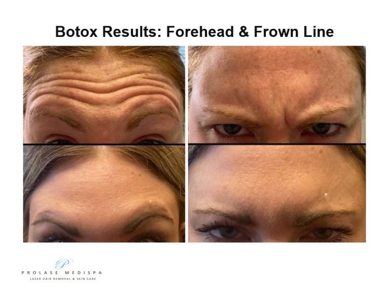 Injectables Photo Gallery - Prolase Medispa | #1 Laser Hair Removal in DMV