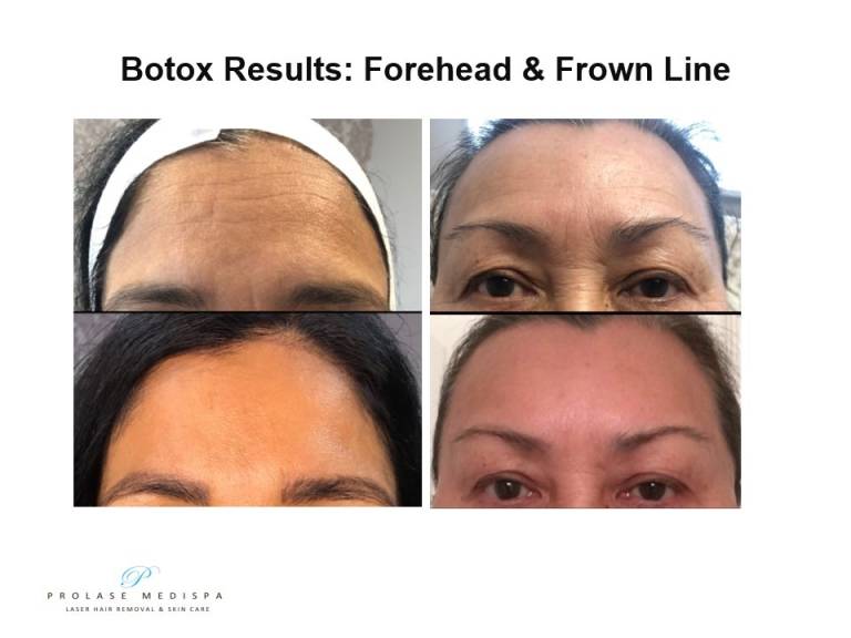 Injectables Photo Gallery - Prolase Medispa | #1 Laser Hair Removal in DMV