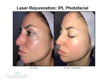 Laser Treatments - Prolase Medispa | #1 Laser Hair Removal in DMV