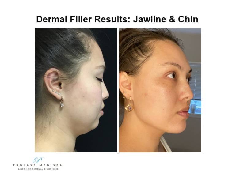 Injectables Photo Gallery - Prolase Medispa | #1 Laser Hair Removal in DMV