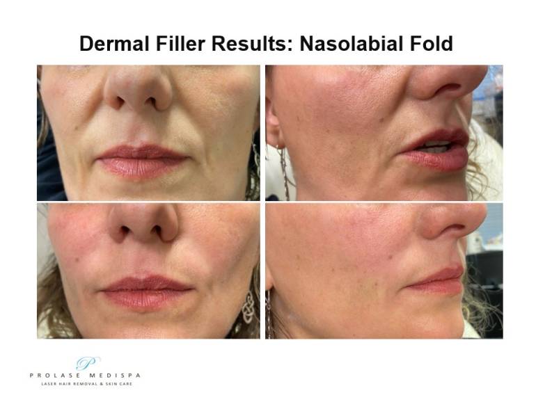 Injectables Photo Gallery - Prolase Medispa | #1 Laser Hair Removal in DMV