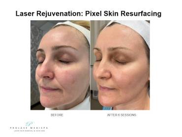 Laser Treatments - Prolase Medispa | #1 Laser Hair Removal in DMV