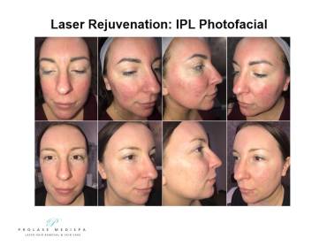 Laser Treatments - Prolase Medispa | #1 Laser Hair Removal in DMV