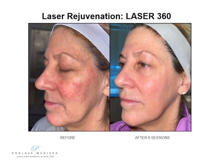 Laser Treatments - Prolase Medispa | #1 Laser Hair Removal in DMV