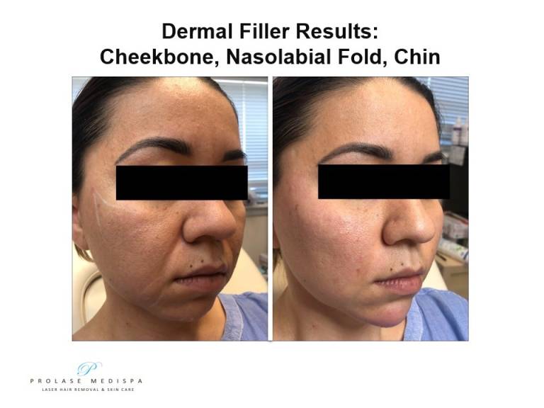 Injectables Photo Gallery - Prolase Medispa | #1 Laser Hair Removal in DMV