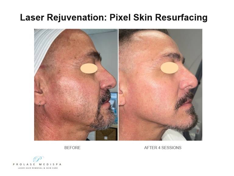 Laser Treatments - Prolase Medispa | #1 Laser Hair Removal in DMV