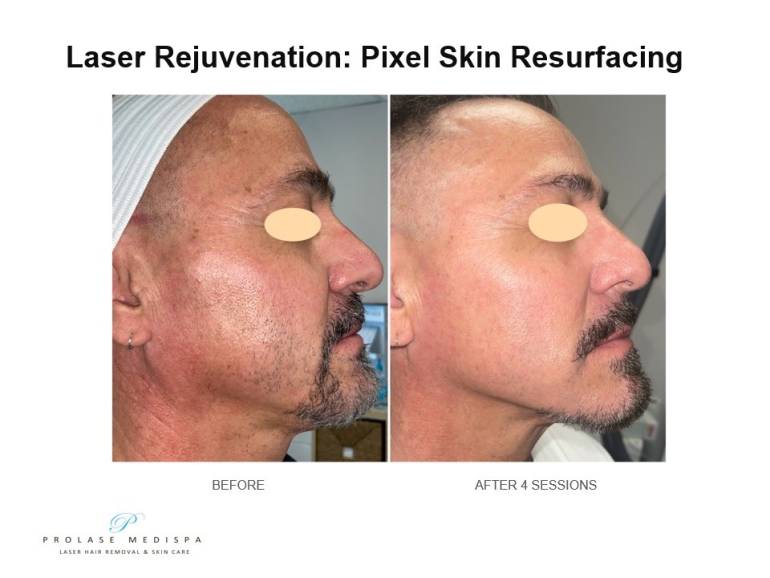 Laser Treatments - Prolase Medispa | #1 Laser Hair Removal in DMV