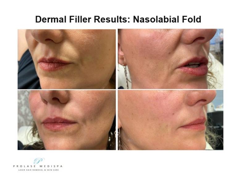 Injectables Photo Gallery - Prolase Medispa | #1 Laser Hair Removal in DMV