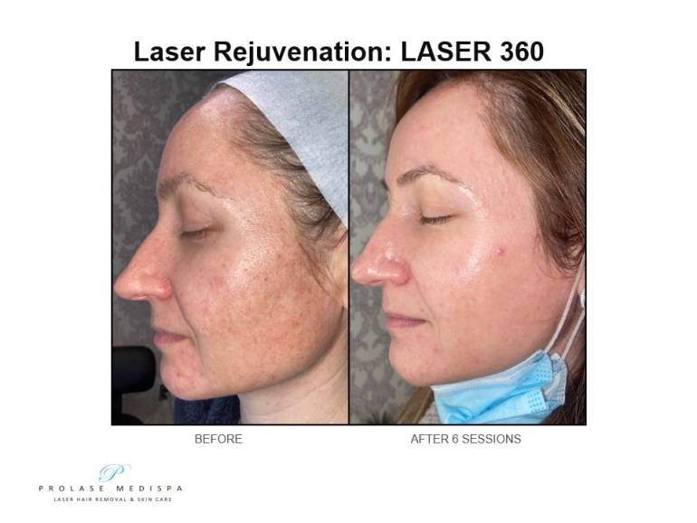 Laser Treatments - Prolase Medispa | #1 Laser Hair Removal in DMV