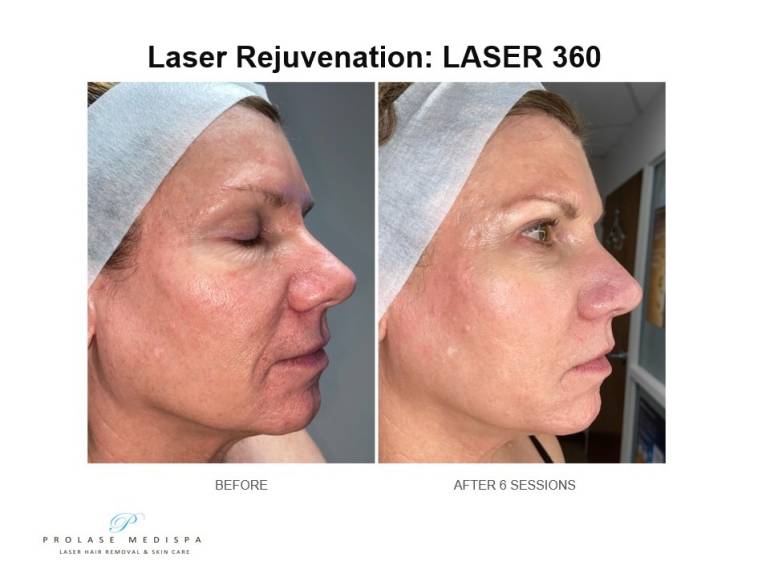 Laser Treatments - Prolase Medispa | #1 Laser Hair Removal in DMV