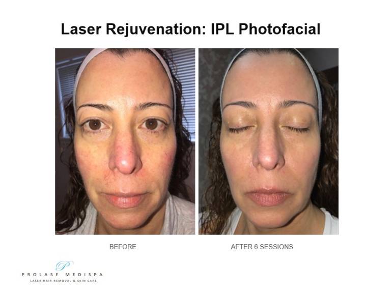 Laser Treatments - Prolase Medispa | #1 Laser Hair Removal in DMV