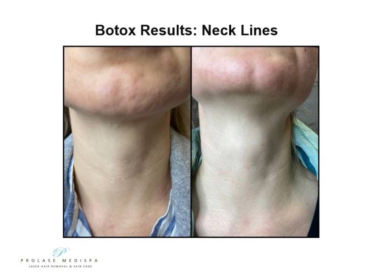 Injectables Photo Gallery - Prolase Medispa | #1 Laser Hair Removal in DMV