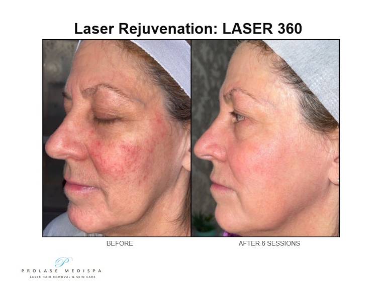 Laser Treatments - Prolase Medispa | #1 Laser Hair Removal in DMV