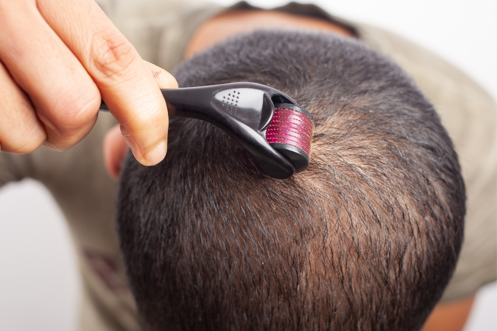 Factors That Affect Microneedling Cost in Falls Church, Virginia ...