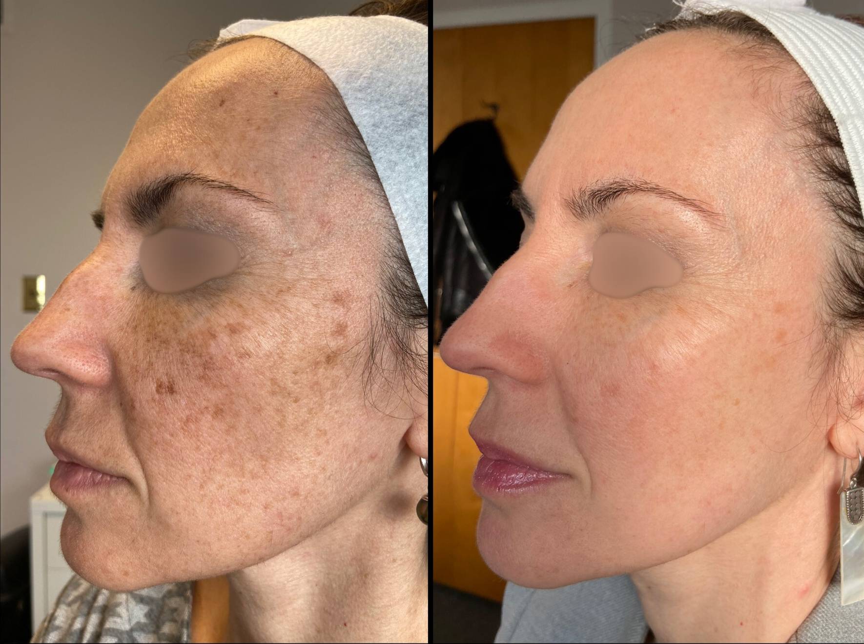 Home - Prolase Medispa | #1 Laser Hair Removal in DMV